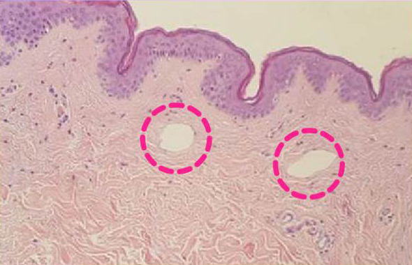 피코플러스 레이저토닝 | 디아트의원 - 청주피부과